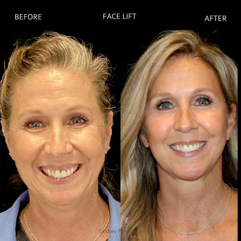Deep Plane Facelift Shreveport | Deep Plane Facelift Surgeon – Lindsey ...